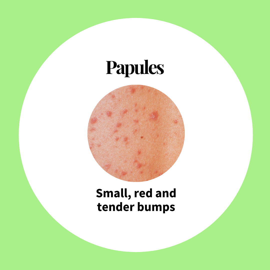 Acne Treatments: Everything You Need to Know